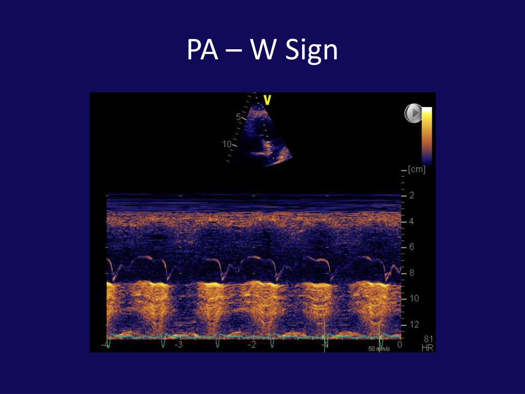PPT - Role of the Echocardiogram in the Assessment of Pulmonary ...