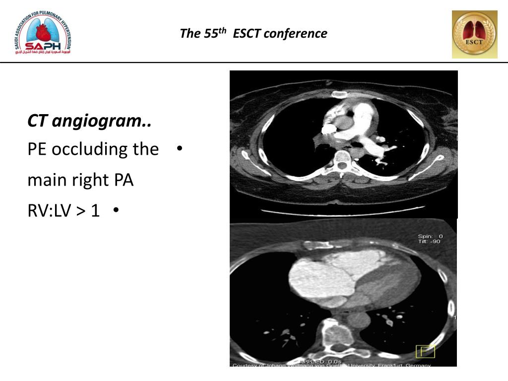 Ppt Treatment Of Submassive Pulmonary Embolism Is Thrombolysis The