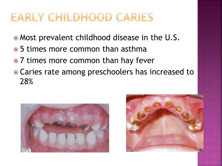 PPT - Early Childhood Caries PowerPoint Presentation - ID:2168545