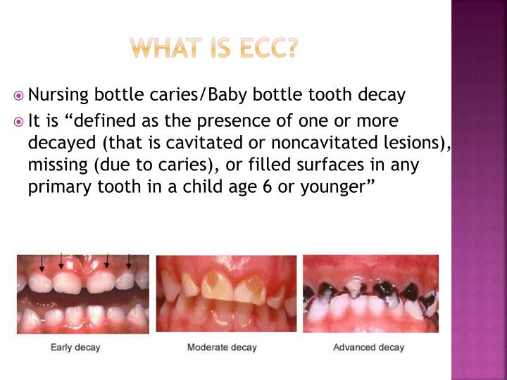PPT - Early Childhood Caries PowerPoint Presentation - ID:2168545