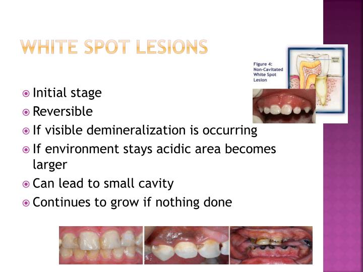 PPT - Early Childhood Caries PowerPoint Presentation - ID:2168545