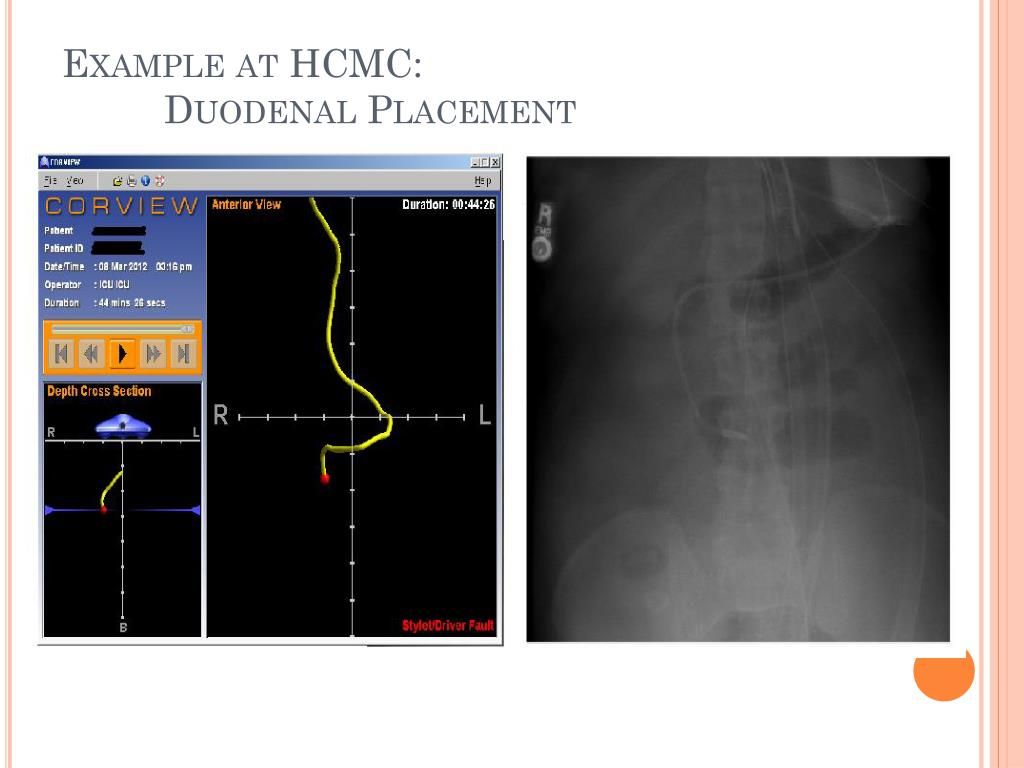 PPT - Feeding Tube Placements: Dietitian training and the Procedure ...