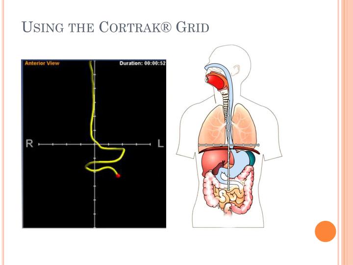 PPT - Feeding Tube Placements: Dietitian training and the Procedure ...