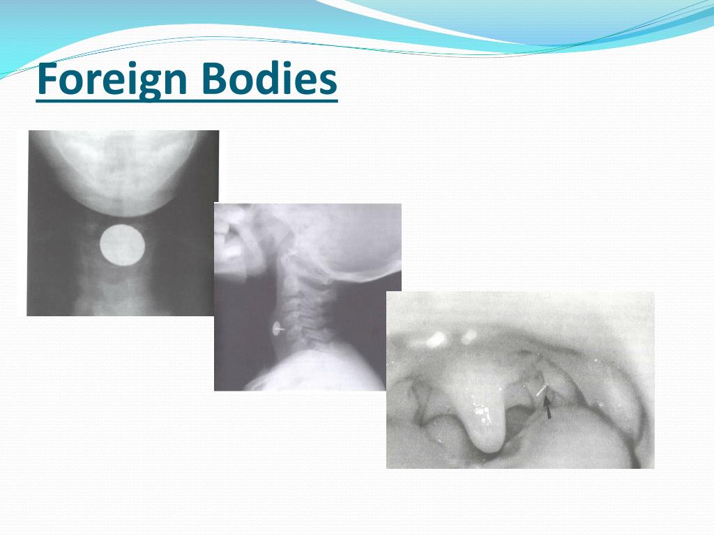 PPT - MANAGEMENT OF DYSPHAGIA PowerPoint Presentation, free download ...