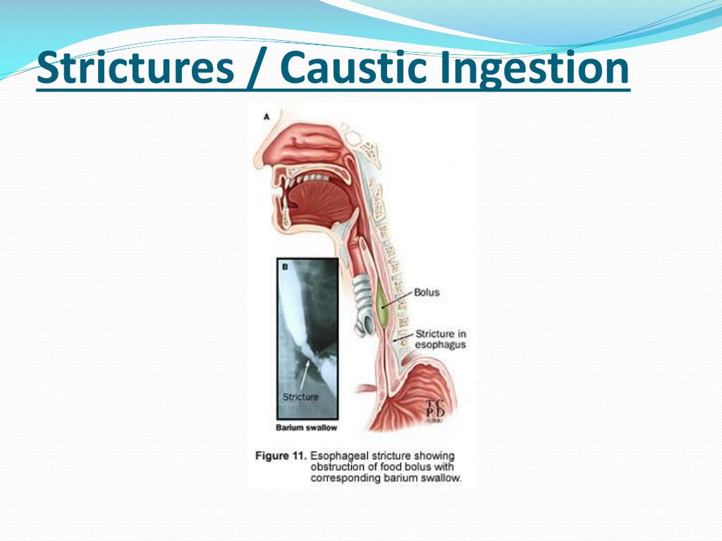 PPT - MANAGEMENT OF DYSPHAGIA PowerPoint Presentation, free download ...