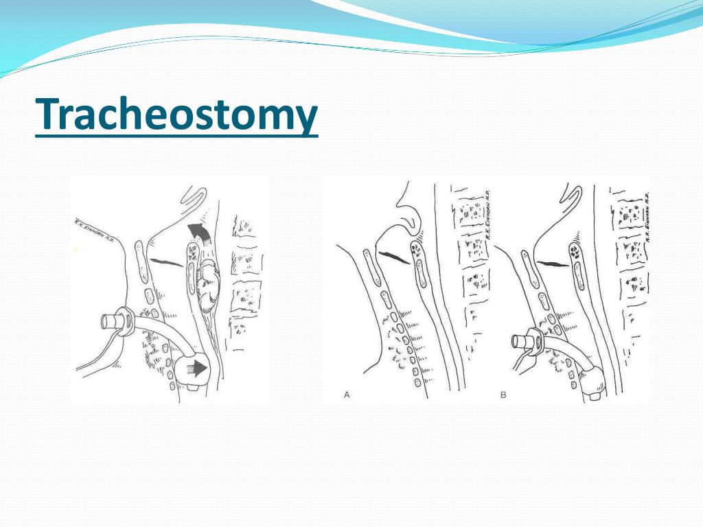 PPT - MANAGEMENT OF DYSPHAGIA PowerPoint Presentation, free download ...