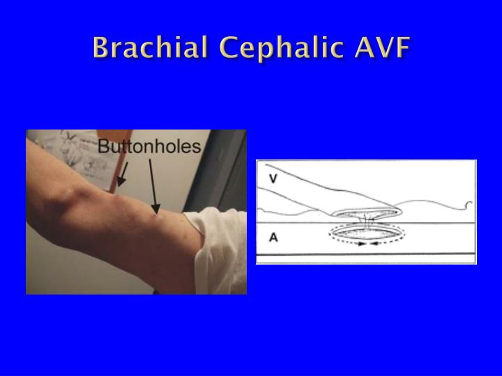 PPT - SURGICAL MANAGEMENT OF DIALYSIS ACCESS PowerPoint Presentation ...