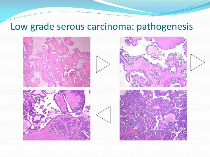 PPT - Ovarian borderline tumors PowerPoint Presentation - ID:2175035