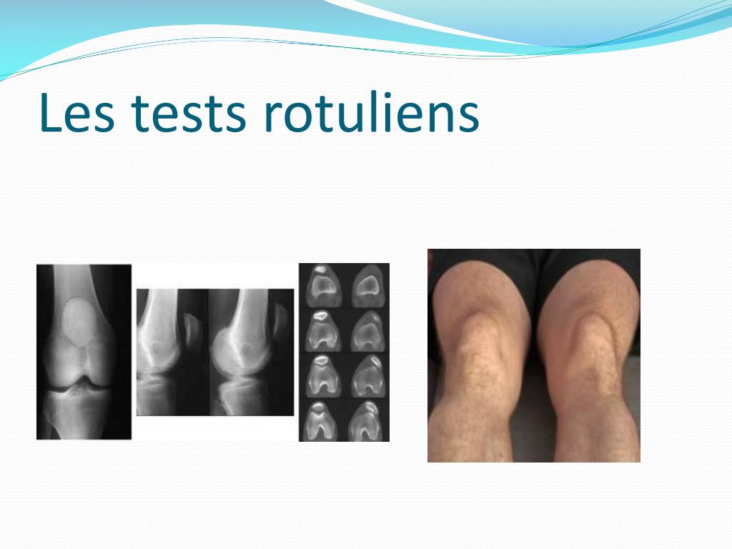 PPT - EXAMEN CLINIQUE DU GENOU Docteur Alain MOUTET (Marseille ...