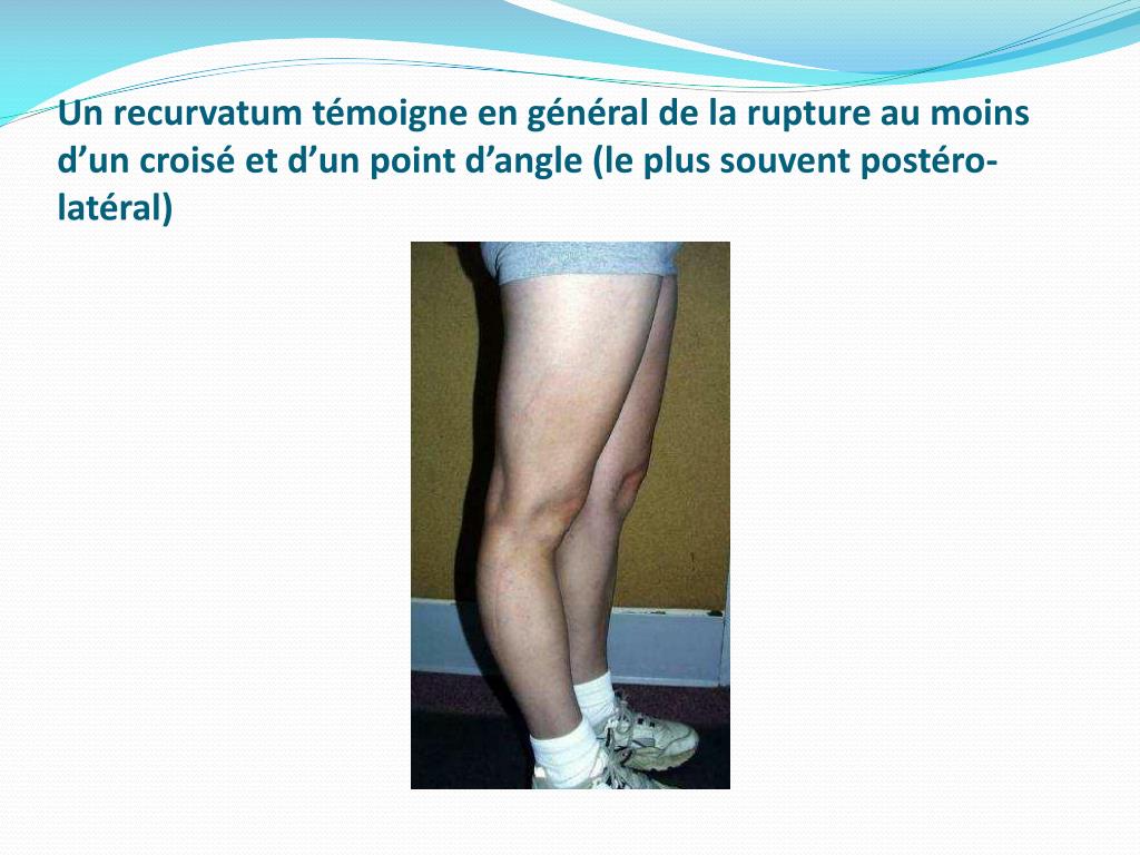 PPT - EXAMEN CLINIQUE DU GENOU Docteur Alain MOUTET (Marseille ...