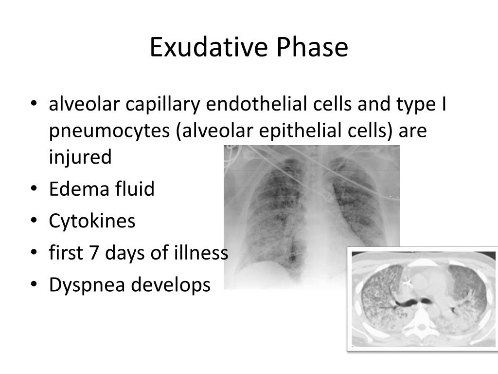 PPT - ARDS (Acute Respiratory Distress Syndrome) PowerPoint ...