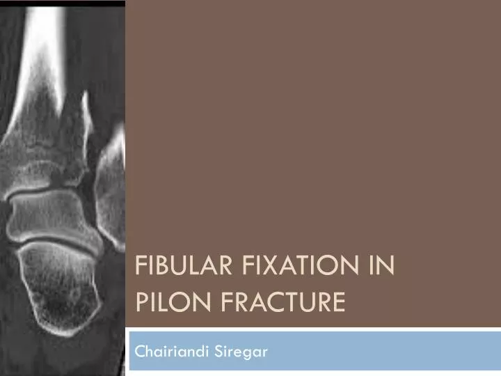 PPT - FIBULAR FIXATION IN Pilon F RACTURE PowerPoint Presentation, free ...