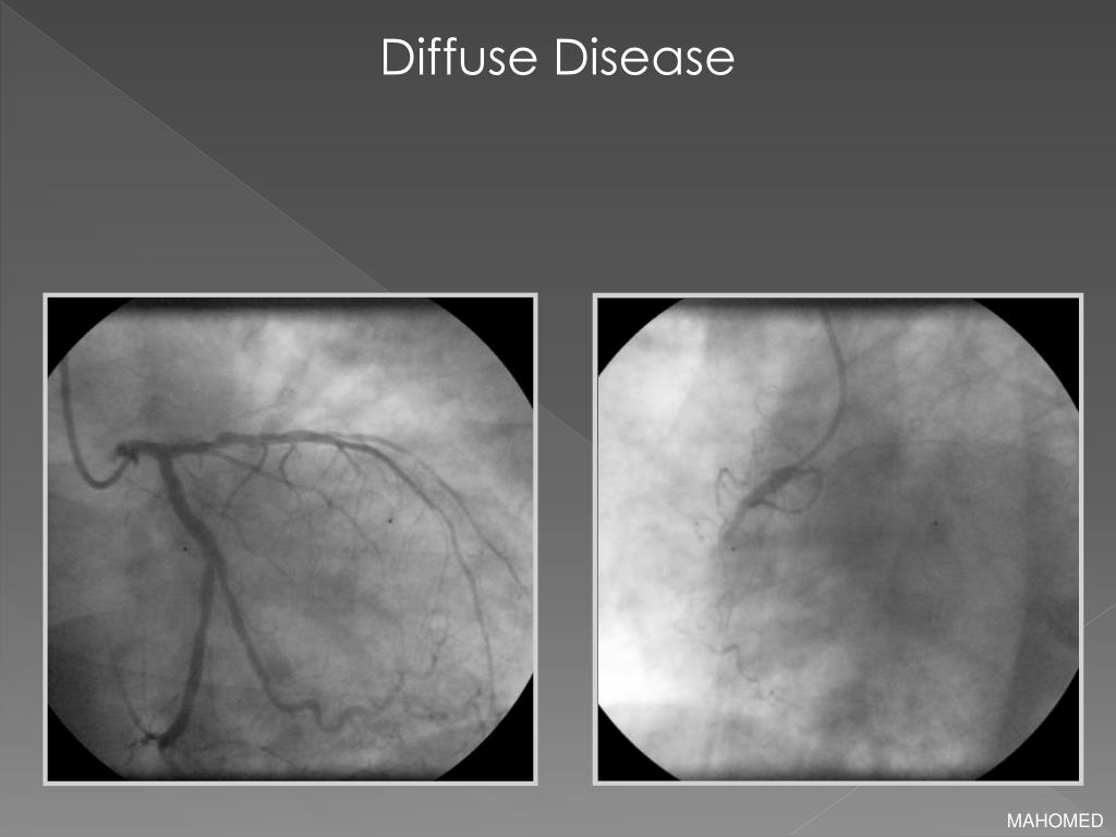 PPT - ISCHAEMIC HEART DISEASE Acute Coronary Syndromes PowerPoint ...