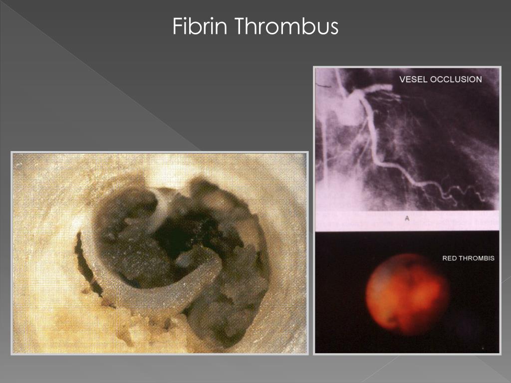 PPT - ISCHAEMIC HEART DISEASE Acute Coronary Syndromes PowerPoint ...