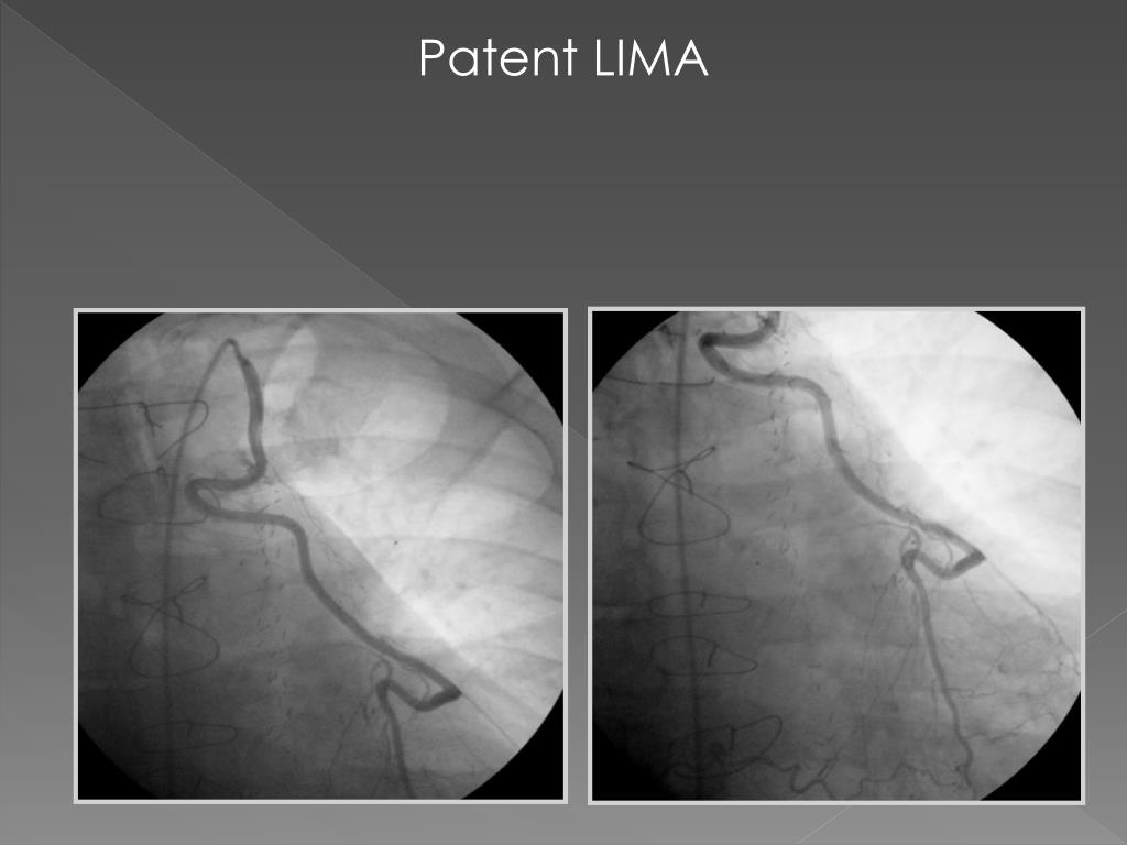 PPT - ISCHAEMIC HEART DISEASE Acute Coronary Syndromes PowerPoint ...