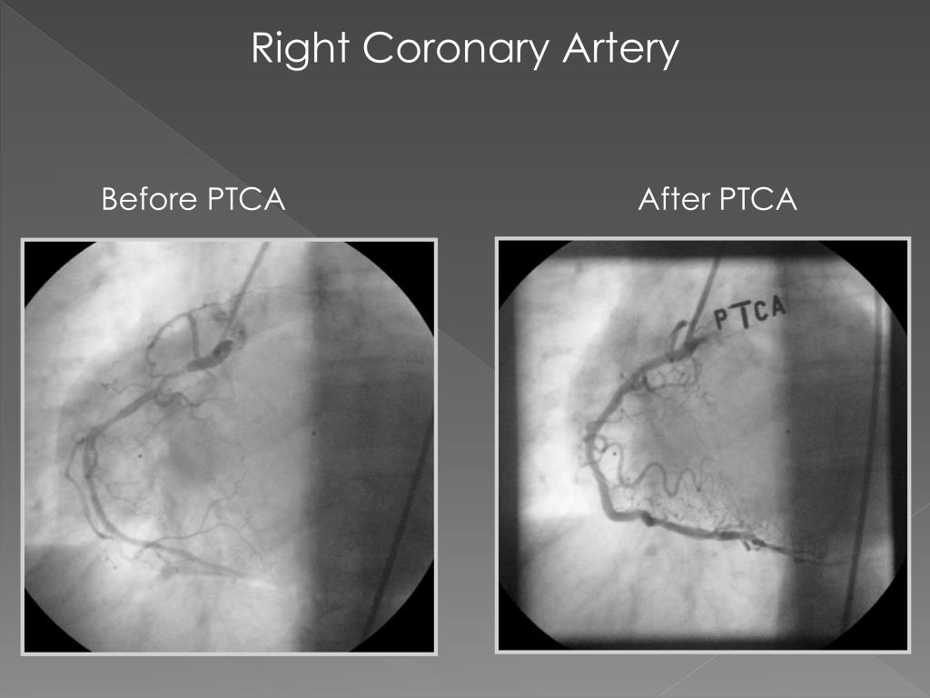 PPT - ISCHAEMIC HEART DISEASE Acute Coronary Syndromes PowerPoint ...
