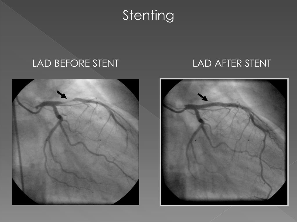 PPT - ISCHAEMIC HEART DISEASE Acute Coronary Syndromes PowerPoint ...