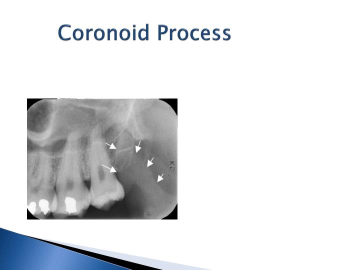 PPT - EO 005.06 Normal Intraoral Radiographic Anatomy PowerPoint ...