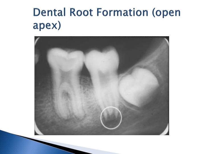PPT - EO 005.06 Normal Intraoral Radiographic Anatomy PowerPoint ...