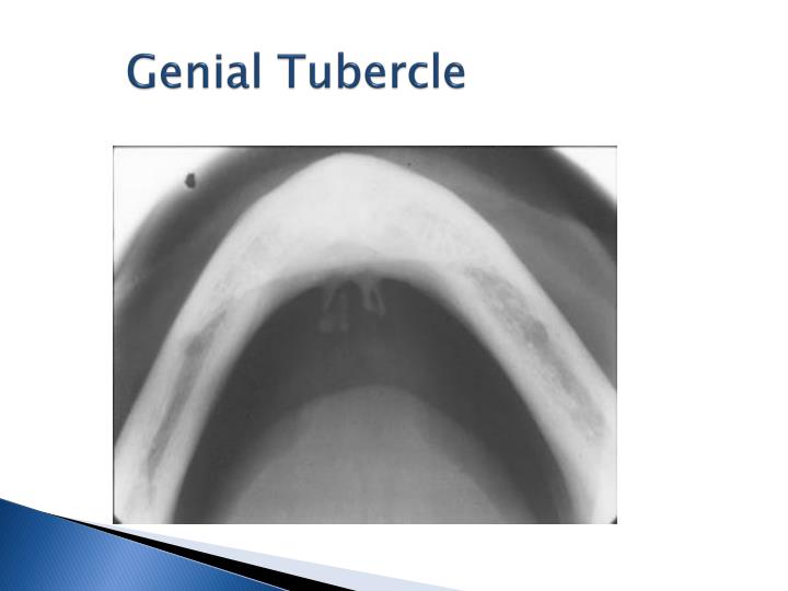 PPT - EO 005.06 Normal Intraoral Radiographic Anatomy PowerPoint ...