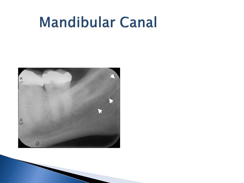 PPT - EO 005.06 Normal Intraoral Radiographic Anatomy PowerPoint ...