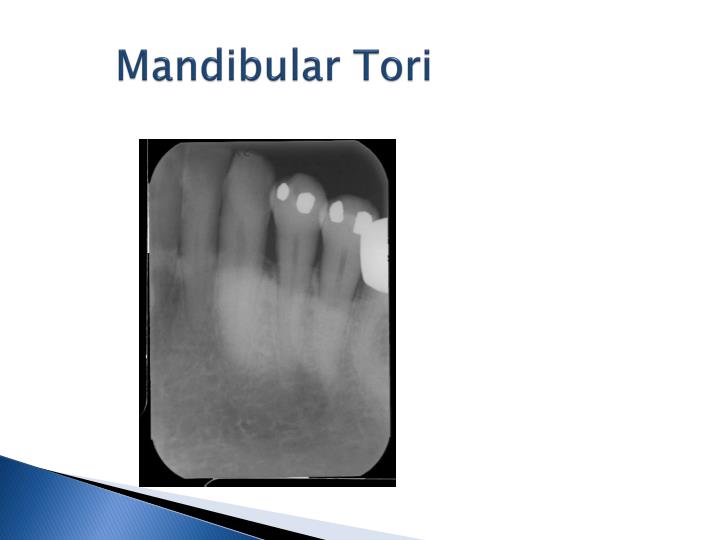 PPT - EO 005.06 Normal Intraoral Radiographic Anatomy PowerPoint ...