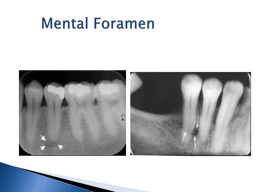 PPT - EO 005.06 Normal Intraoral Radiographic Anatomy PowerPoint ...