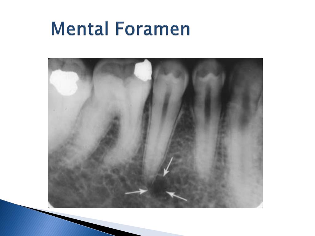 PPT - EO 005.06 Normal Intraoral Radiographic Anatomy PowerPoint ...