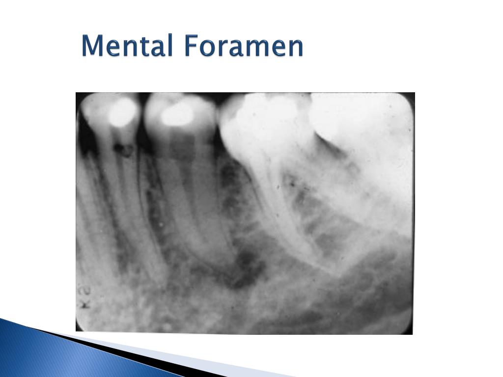 PPT - EO 005.06 Normal Intraoral Radiographic Anatomy PowerPoint ...