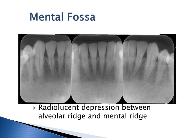 PPT - EO 005.06 Normal Intraoral Radiographic Anatomy PowerPoint ...