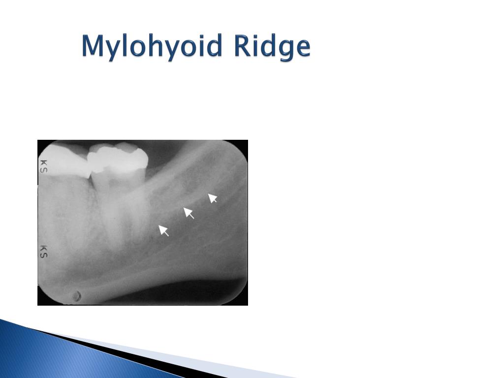 PPT - EO 005.06 Normal Intraoral Radiographic Anatomy PowerPoint ...