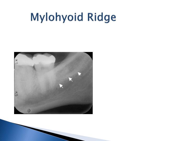 PPT - EO 005.06 Normal Intraoral Radiographic Anatomy PowerPoint ...
