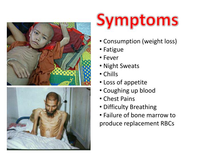 PPT - Tuberculosis PowerPoint Presentation - ID:2176707