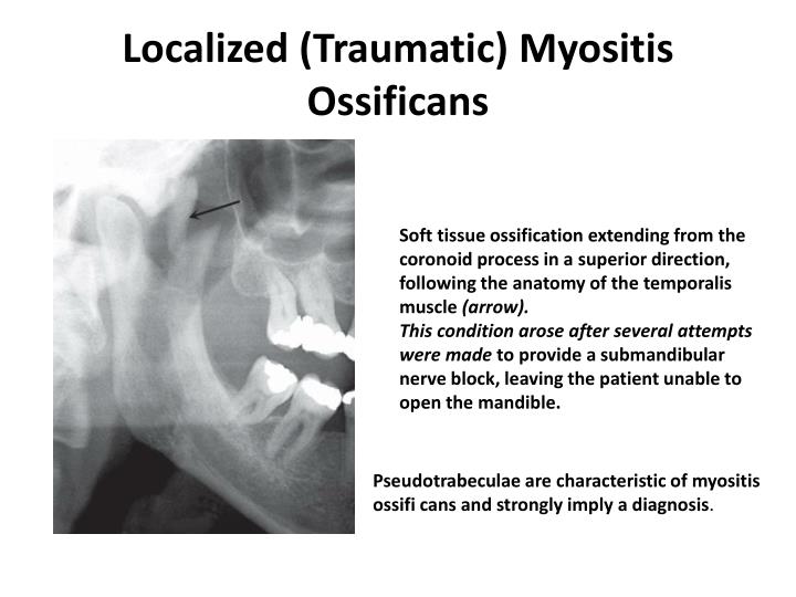 PPT - SOFT TISSUE CALCIFICATION AND OSSIFICATION PowerPoint ...