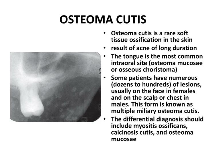 PPT - SOFT TISSUE CALCIFICATION AND OSSIFICATION PowerPoint ...