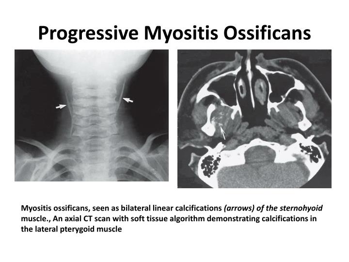 PPT - SOFT TISSUE CALCIFICATION AND OSSIFICATION PowerPoint ...