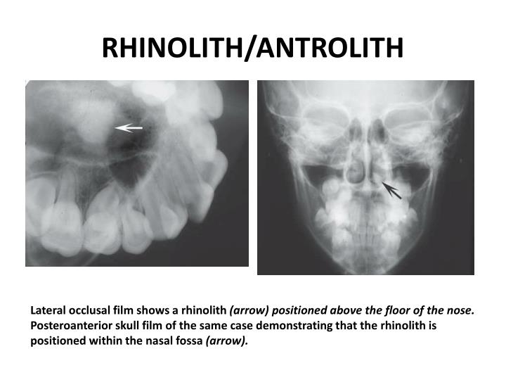 PPT - SOFT TISSUE CALCIFICATION AND OSSIFICATION PowerPoint ...