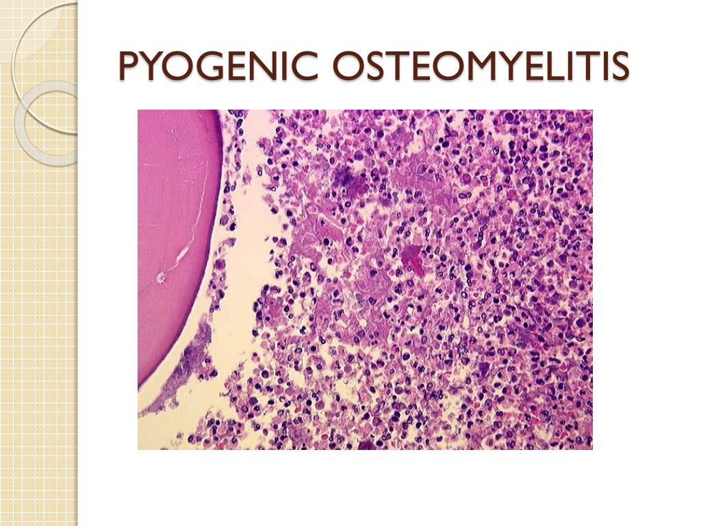 PPT - MUSCULOSKELETAL BLOCK Pathology OSTEOMYELITIS and SEPTIC ...