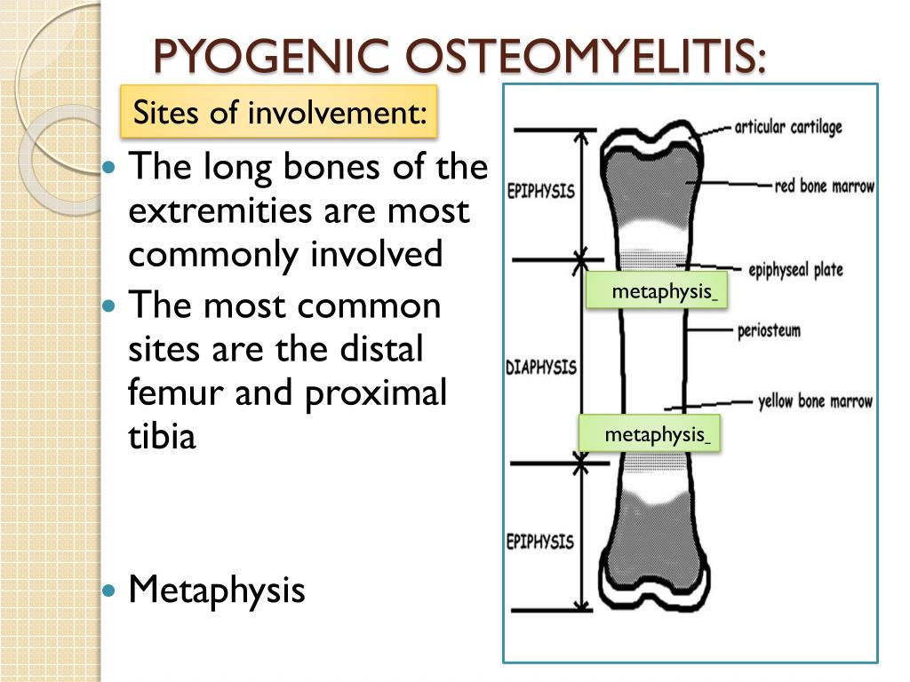 PPT - MUSCULOSKELETAL BLOCK Pathology OSTEOMYELITIS and SEPTIC ...