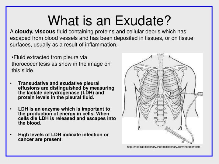 PPT - PLEURAL EFFUSIONS PowerPoint Presentation - ID:2177030