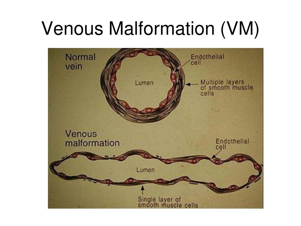 PPT - Updated ISSVA (International Society for the Study of Vascular ...