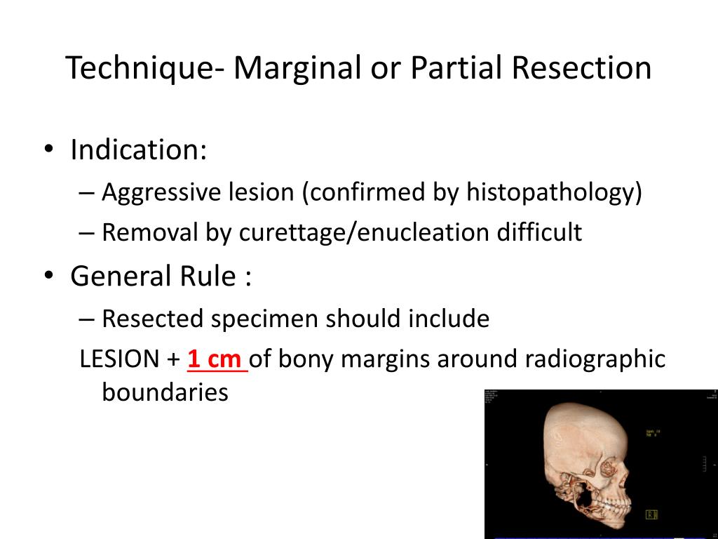 PPT - Surgical Management of Oral Pathological Lesions PowerPoint ...