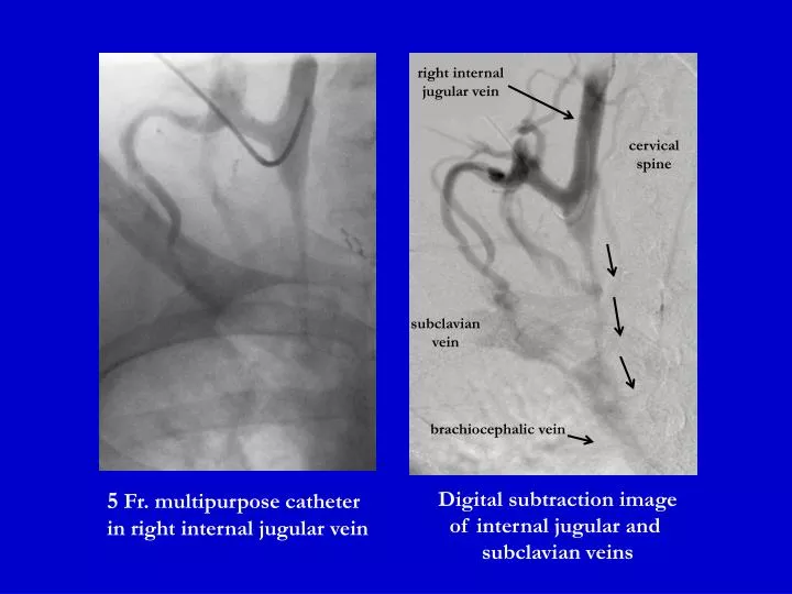 PPT - 5 Fr. multipurpose catheter in right internal jugular vein ...