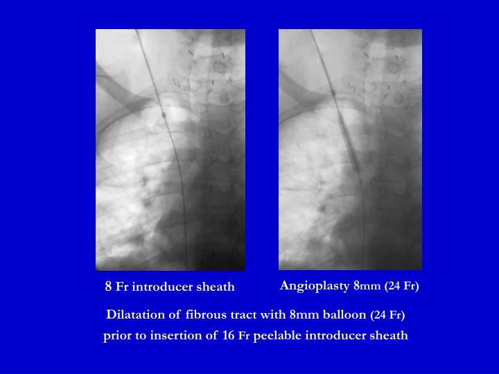 PPT - 5 Fr. multipurpose catheter in right internal jugular vein ...