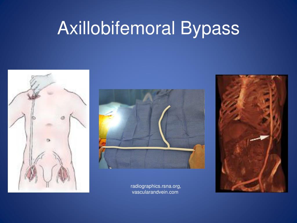 Ppt Case Presentation Axillobifemoral Bypass Powerpoint Presentation Id2179278