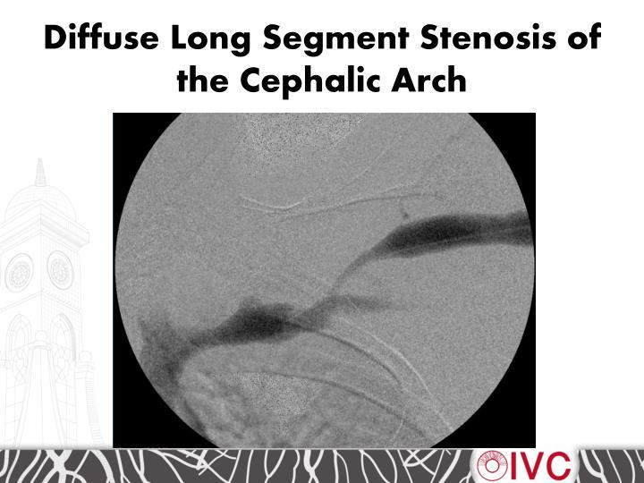 PPT - Toufic Safa , MD, FACS Vascular & Endovascular Surgery St ...