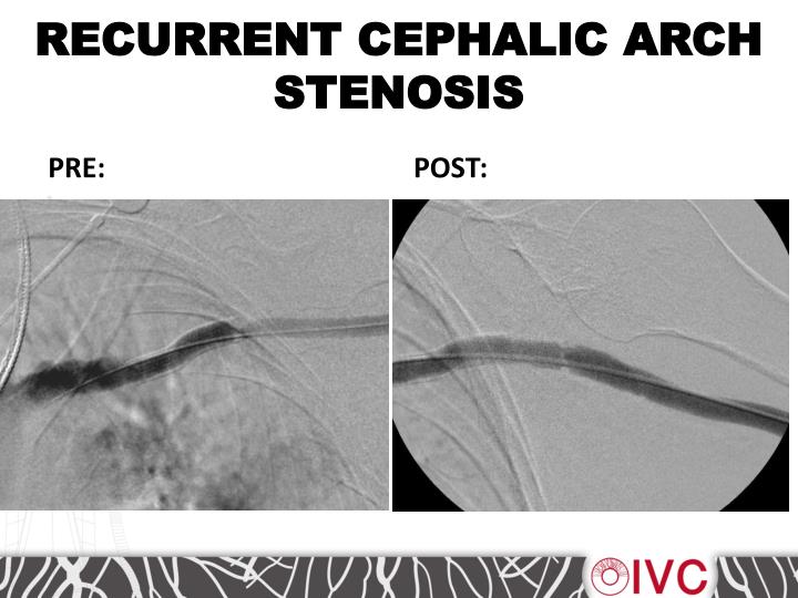 PPT - Toufic Safa , MD, FACS Vascular & Endovascular Surgery St ...