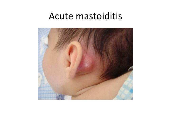 PPT - OTITIS MEDIA (OM) PowerPoint Presentation - ID:2185186