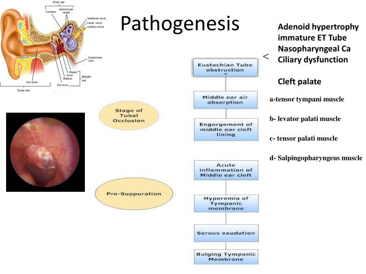 PPT - OTITIS MEDIA (OM) PowerPoint Presentation - ID:2185186