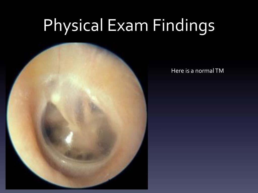 Ppt Otitis Media Powerpoint Presentation Free Download Id2185363